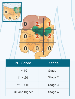 peritoneal malignancy