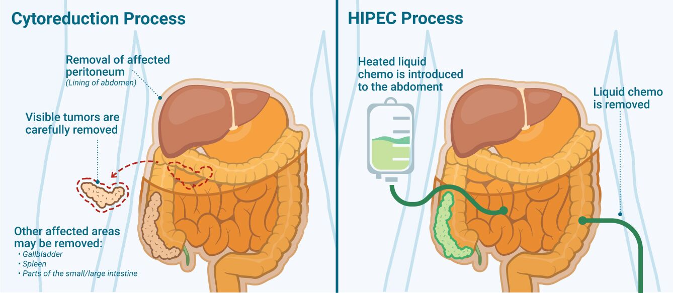 peritoneum cancer treatment