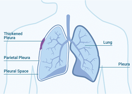 intrapleural space
