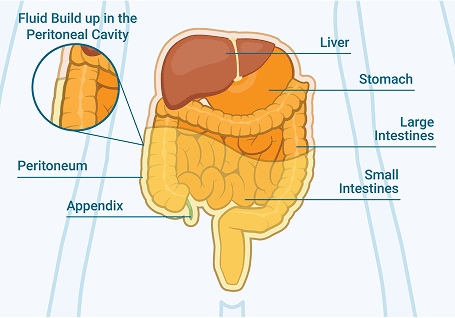 peritoneal cavity fluid